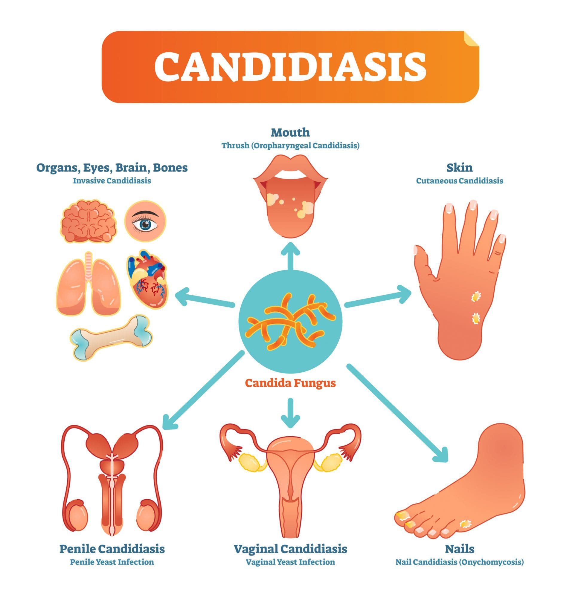 Candida Albicans - Effective Treatment with IBS Clinics