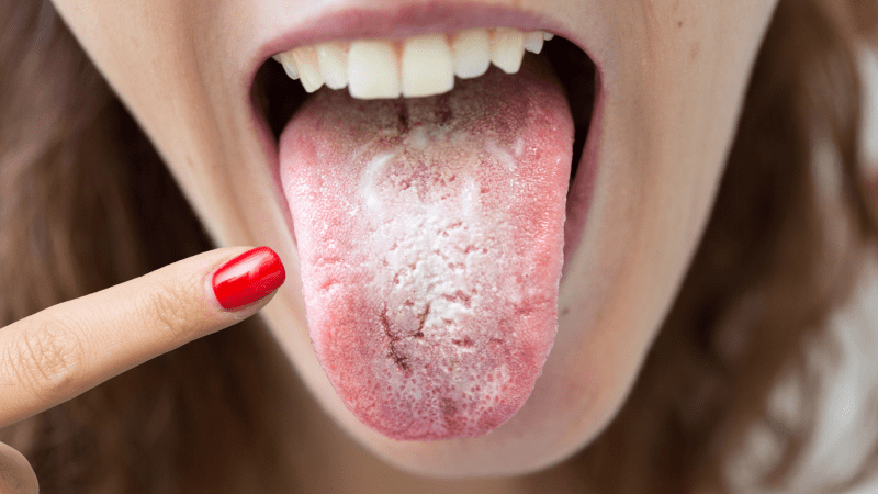 How to Test for Candida - IBS Clinics